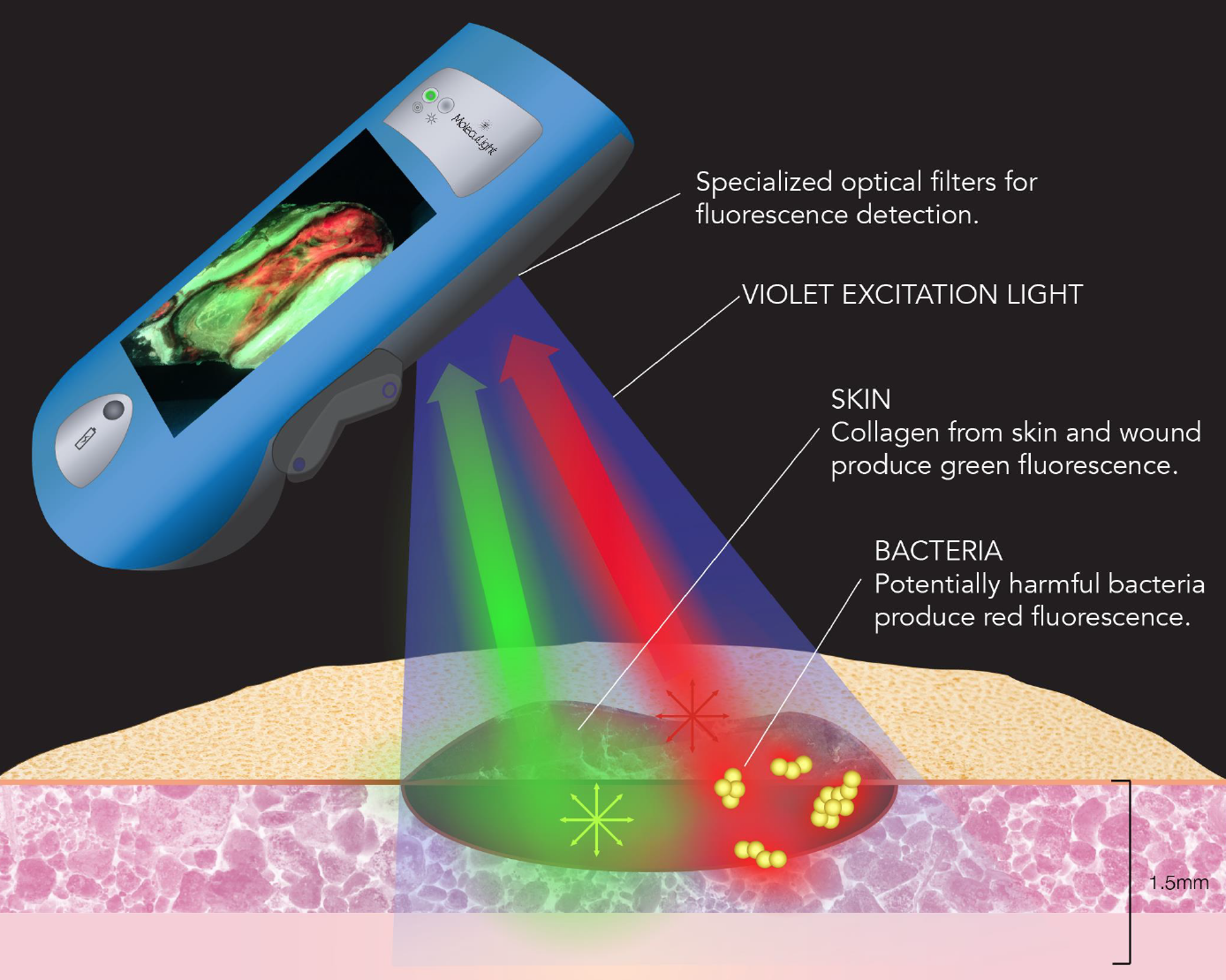 The Use of MolecuLight i:X in Managing Burns – MolecuLight