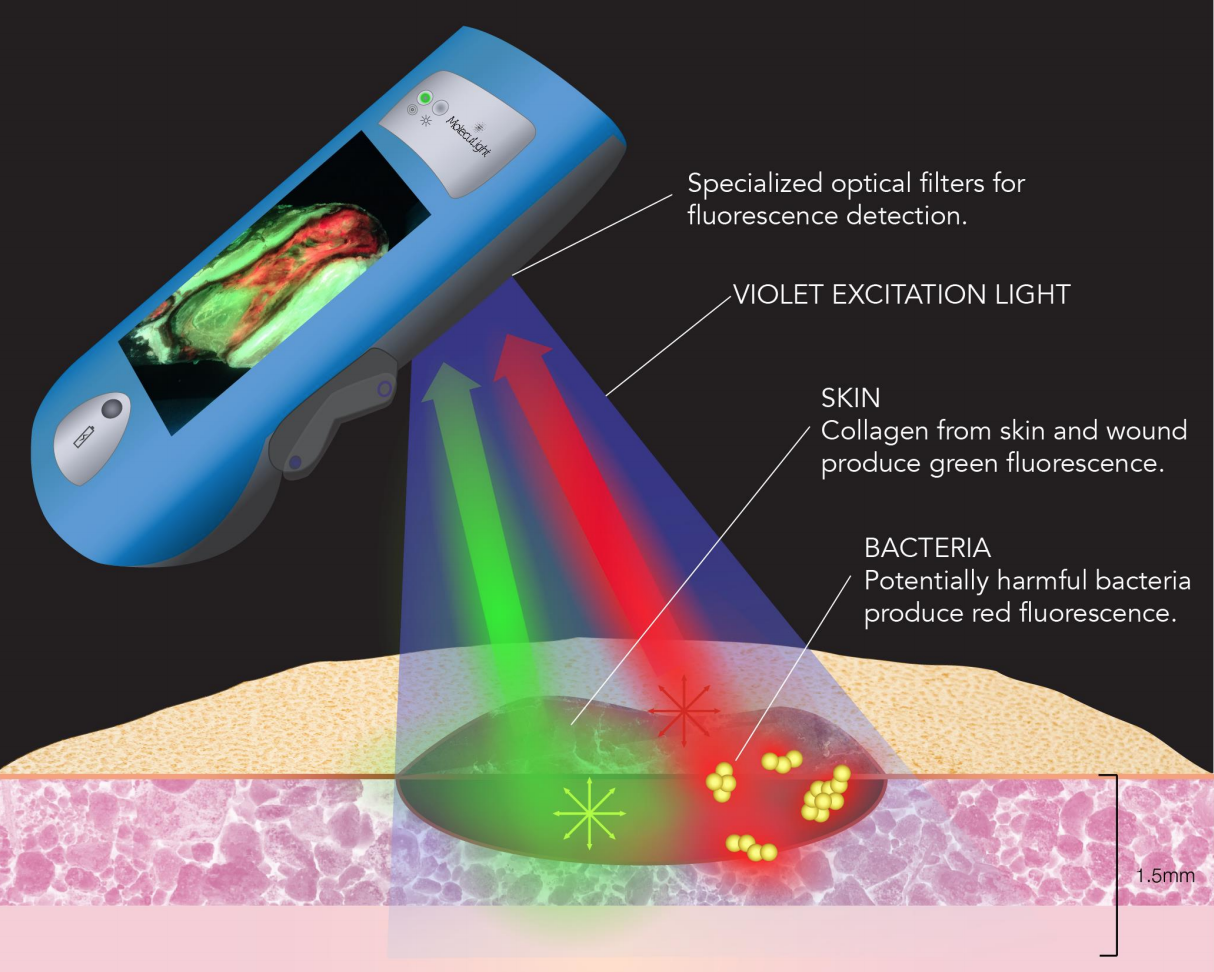 The Role of MolecuLight in Potential Debridement Improvements