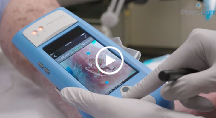 New MolecuLight Enables Faster, More Accurate Wound Measurement